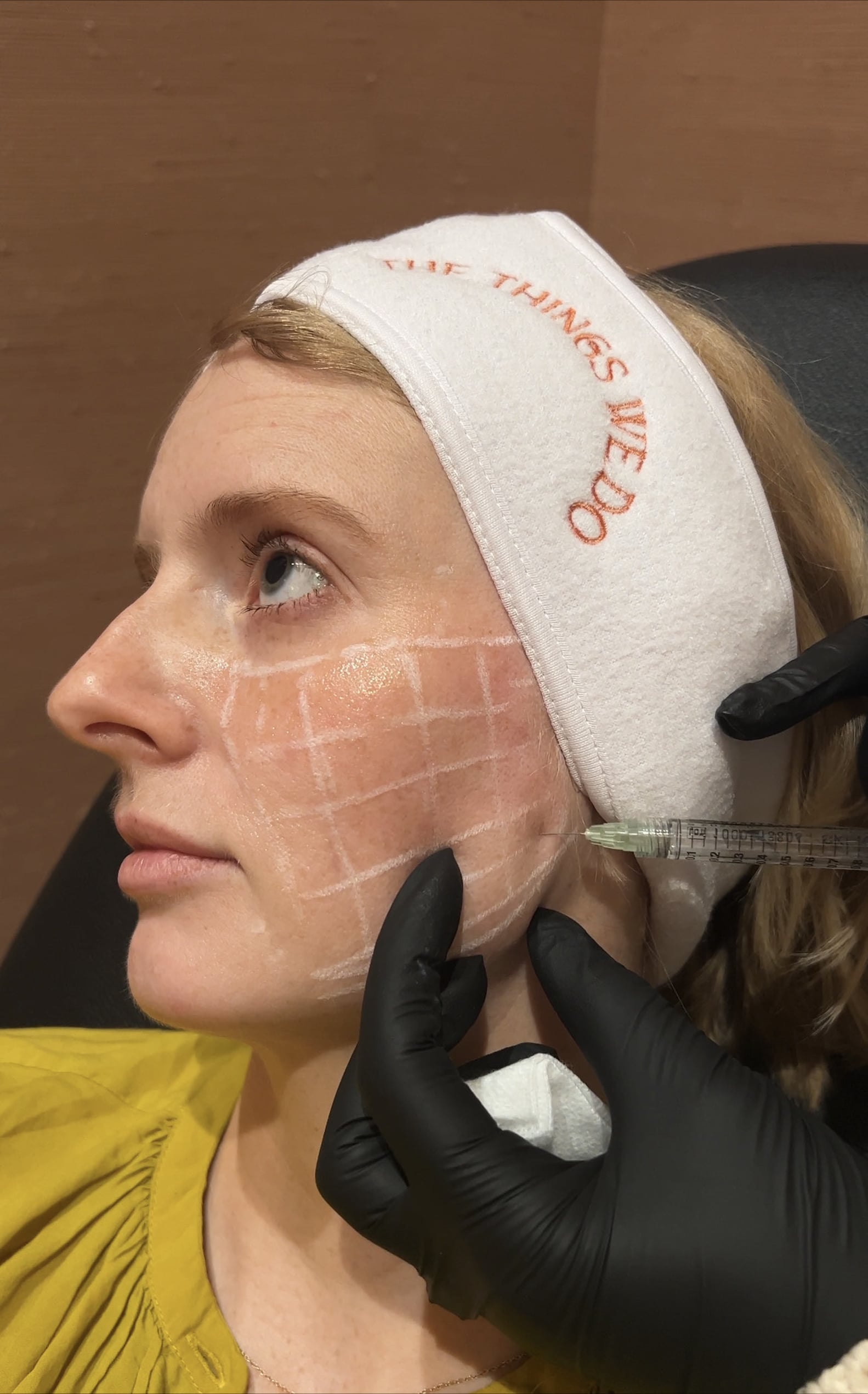 Skinvive Review: I Tried the Injectable Filler | See Photos | PS Beauty