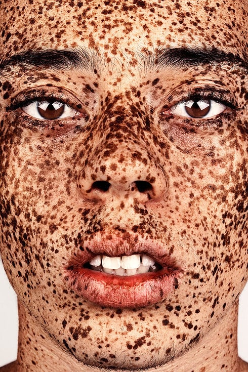 Photos of People With Freckles | PS Beauty
