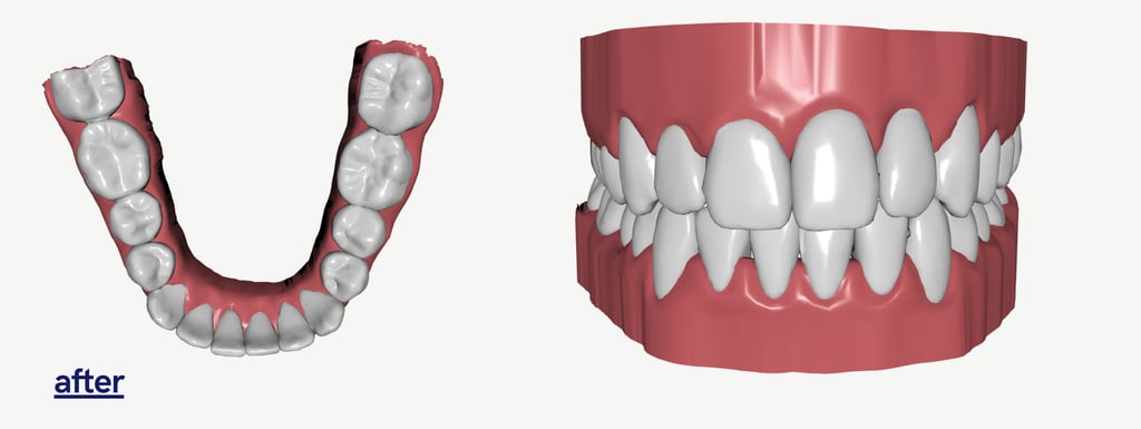 Byte Invisible Aligners Cost and Review | POPSUGAR Beauty UK