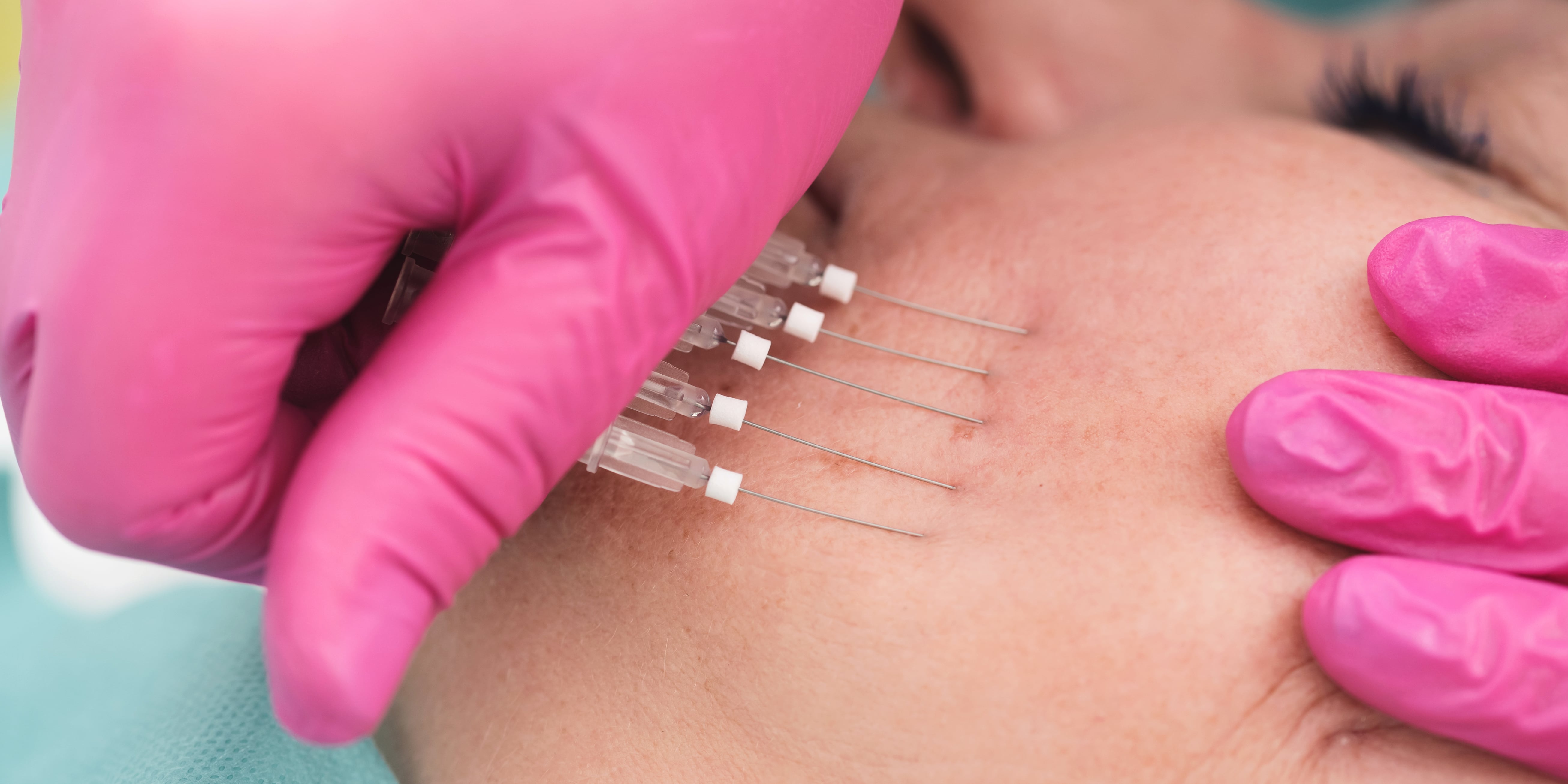 What Are Thread Lifts? | PS Beauty