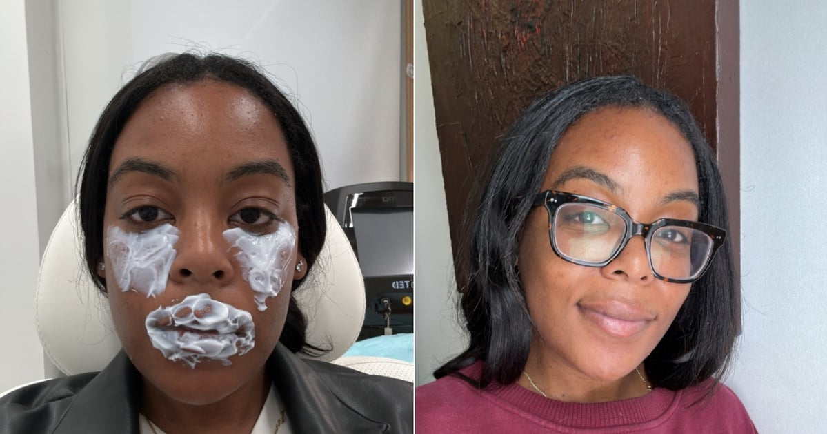 I Tried Restylane Eyelight Undereye Filler: Review, Photos | PS Beauty