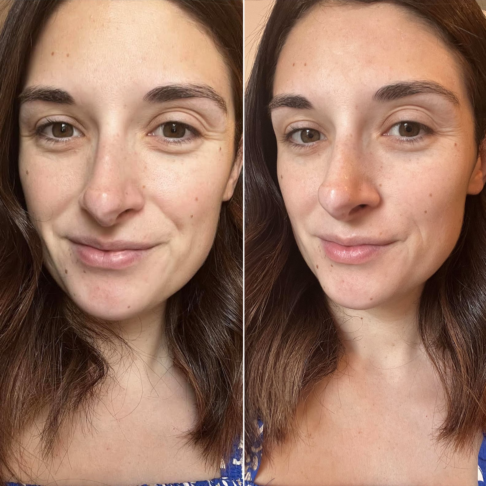 Plump It! No Needles Dermal Filler Review With Photos | PS Beauty