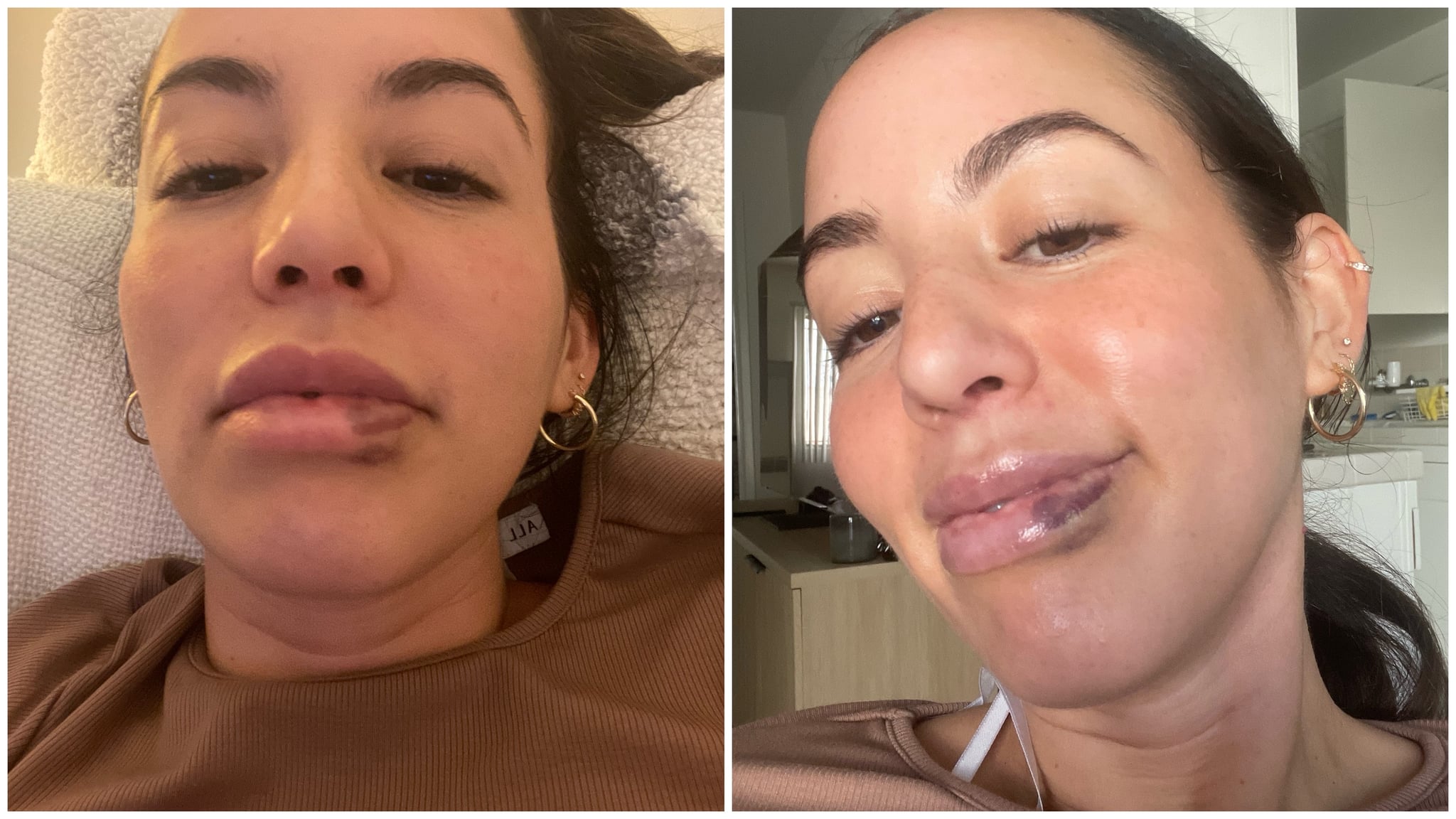 I Got My Lip Filler Dissolved: See Photos | POPSUGAR Beauty UK
