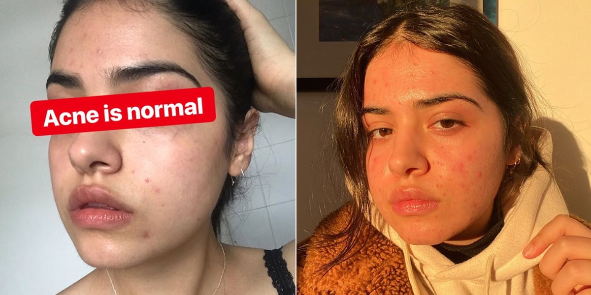 How 1 Woman's Acne Journey Made Her Discover Self-Love | PS Beauty