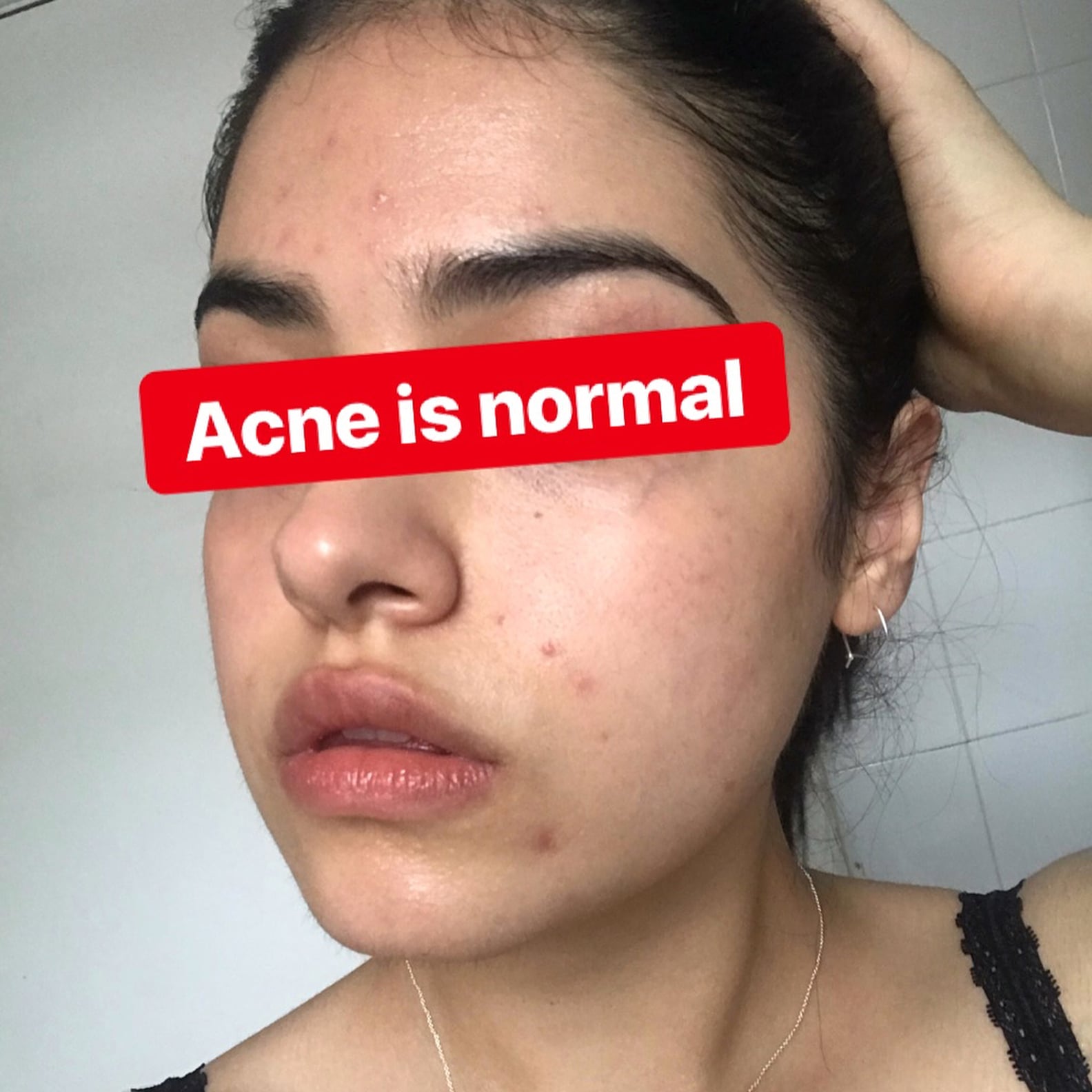 How 1 Woman's Acne Journey Made Her Discover Self-Love | PS Beauty