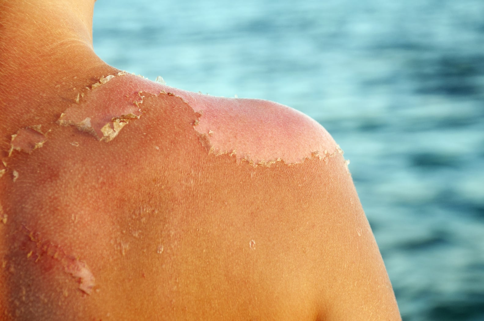 How to Treat and Heal Sunburn Fast | POPSUGAR Beauty
