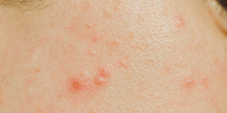 Severe Acne: Types, Treatments, and Tips | POPSUGAR Beauty