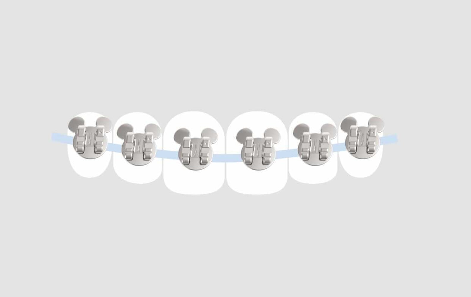 Disney and WildSmiles Braces Mickey Mouse-Shaped Brackets | POPSUGAR Family