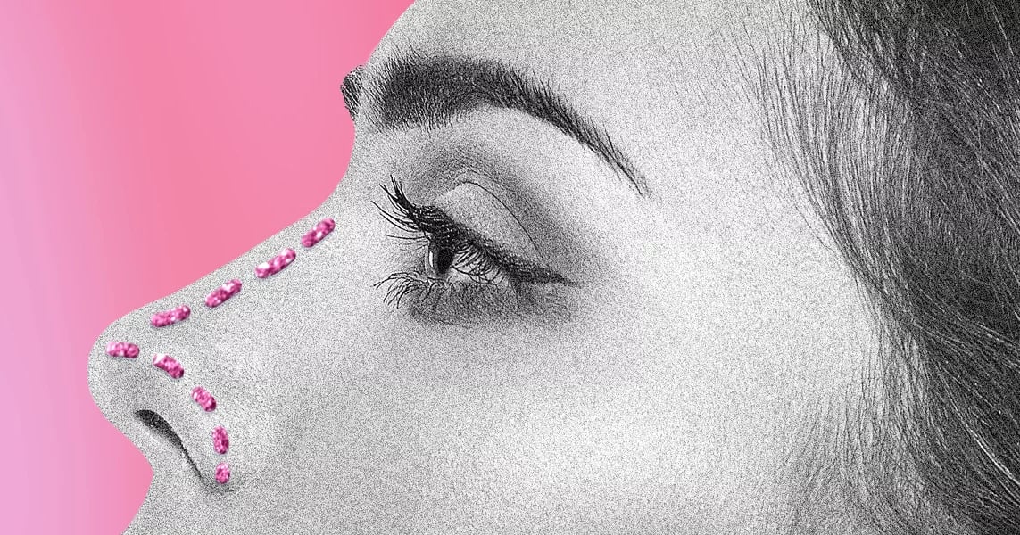 "Tip Lift" Nose Job Procedure: Recovery, Before-and-Afters | PS UK Beauty