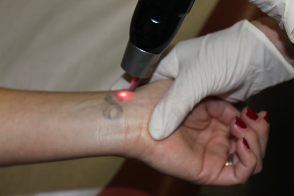 Does It Hurt What It s Like To Have A Tattoo Removed POPSUGAR 