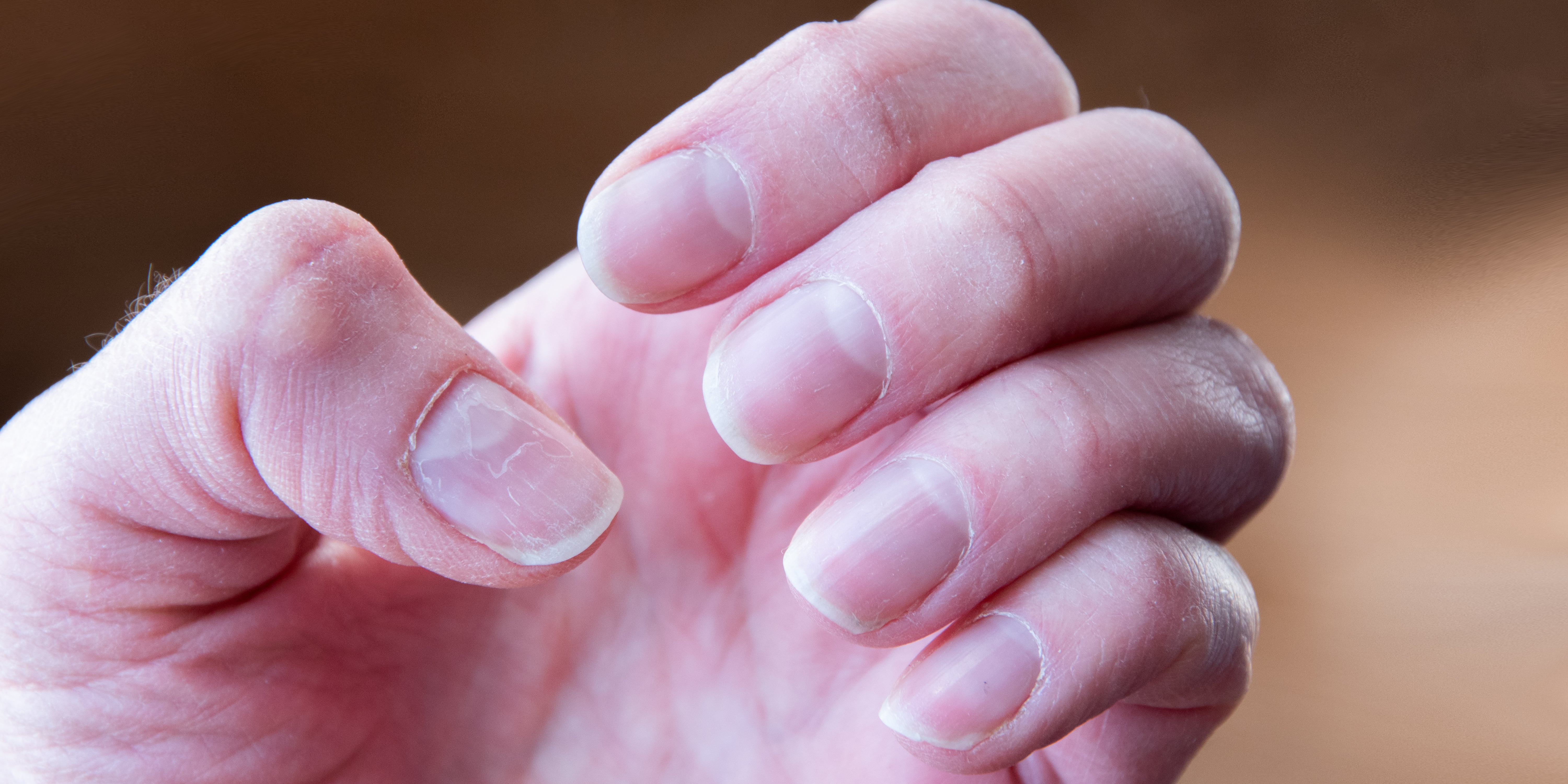 Nail Psoriasis vs. Fungus: Experts Explain the Differences | PS Beauty