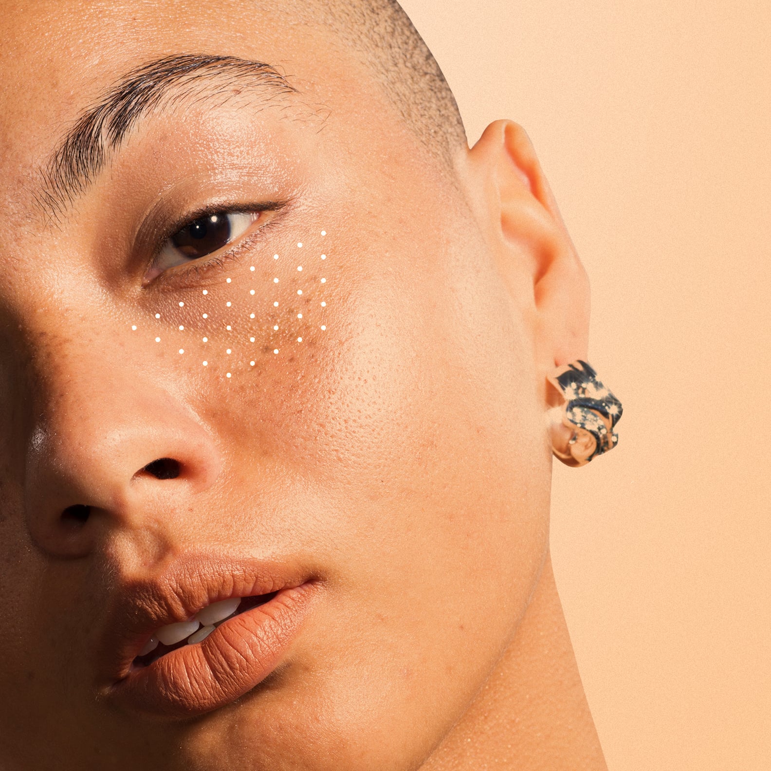 Milia: Causes, Removal, and Treatments | PS Beauty