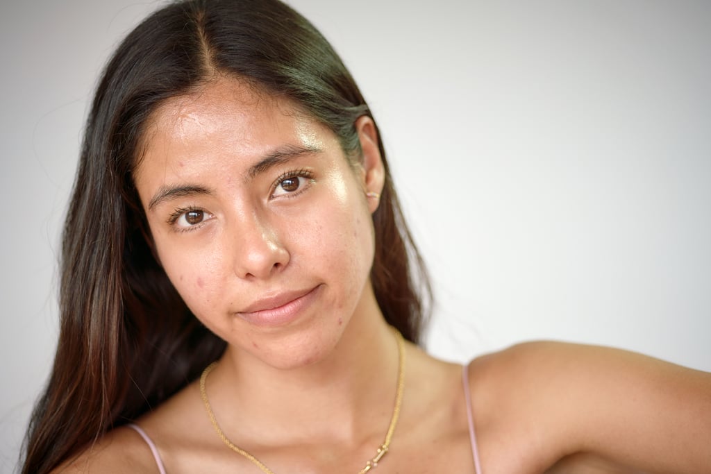 Cheek Breakouts Determining Acne Causes Using Face Mapping POPSUGAR cheek-breakouts-determining-acne-causes-using-face-mapping-popsugar