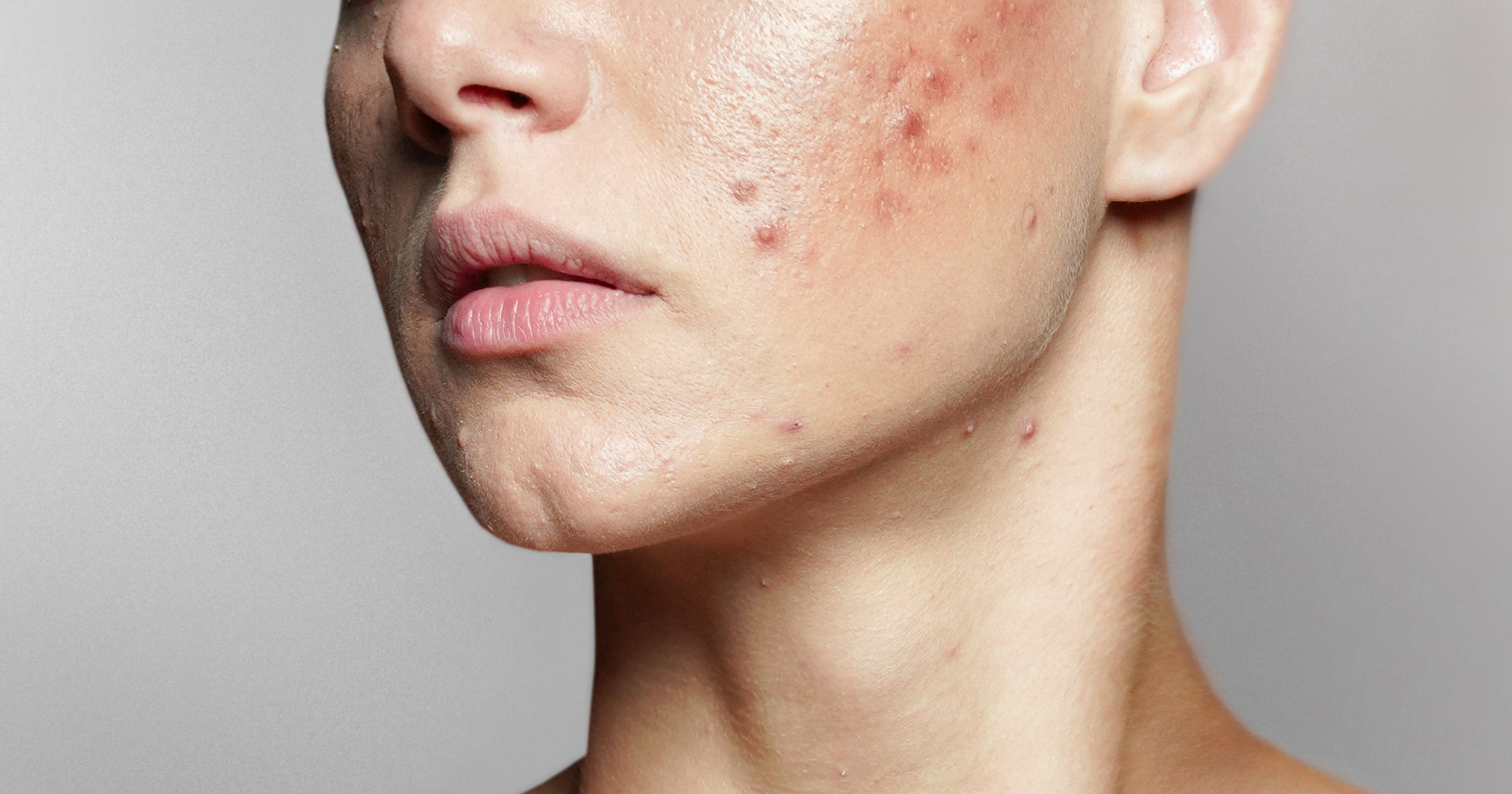 Experts Recommend the Best Acne Treatments For a Flare Up | PS UK Beauty
