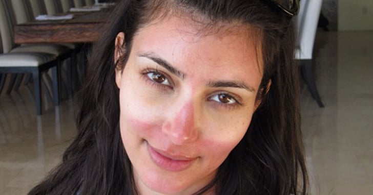 Celebrities With Sunburns | Pictures | POPSUGAR Celebrity