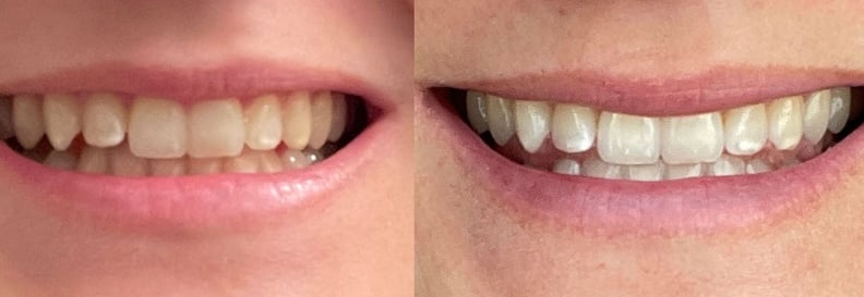 Snow Teeth Whitening Kit Review With Photos | POPSUGAR Beauty