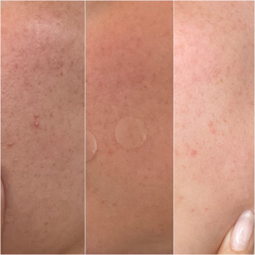 Rael Ultimate Pimple Patch Kit Review With Photos | POPSUGAR Beauty