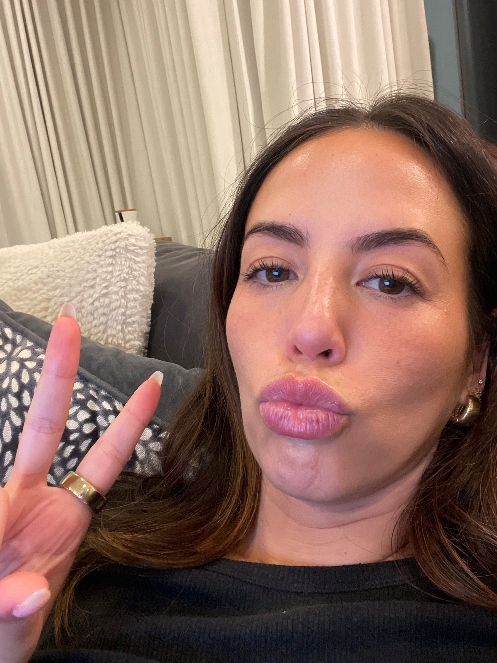 I Got My Lip Filler Dissolved: See Photos | PS Beauty