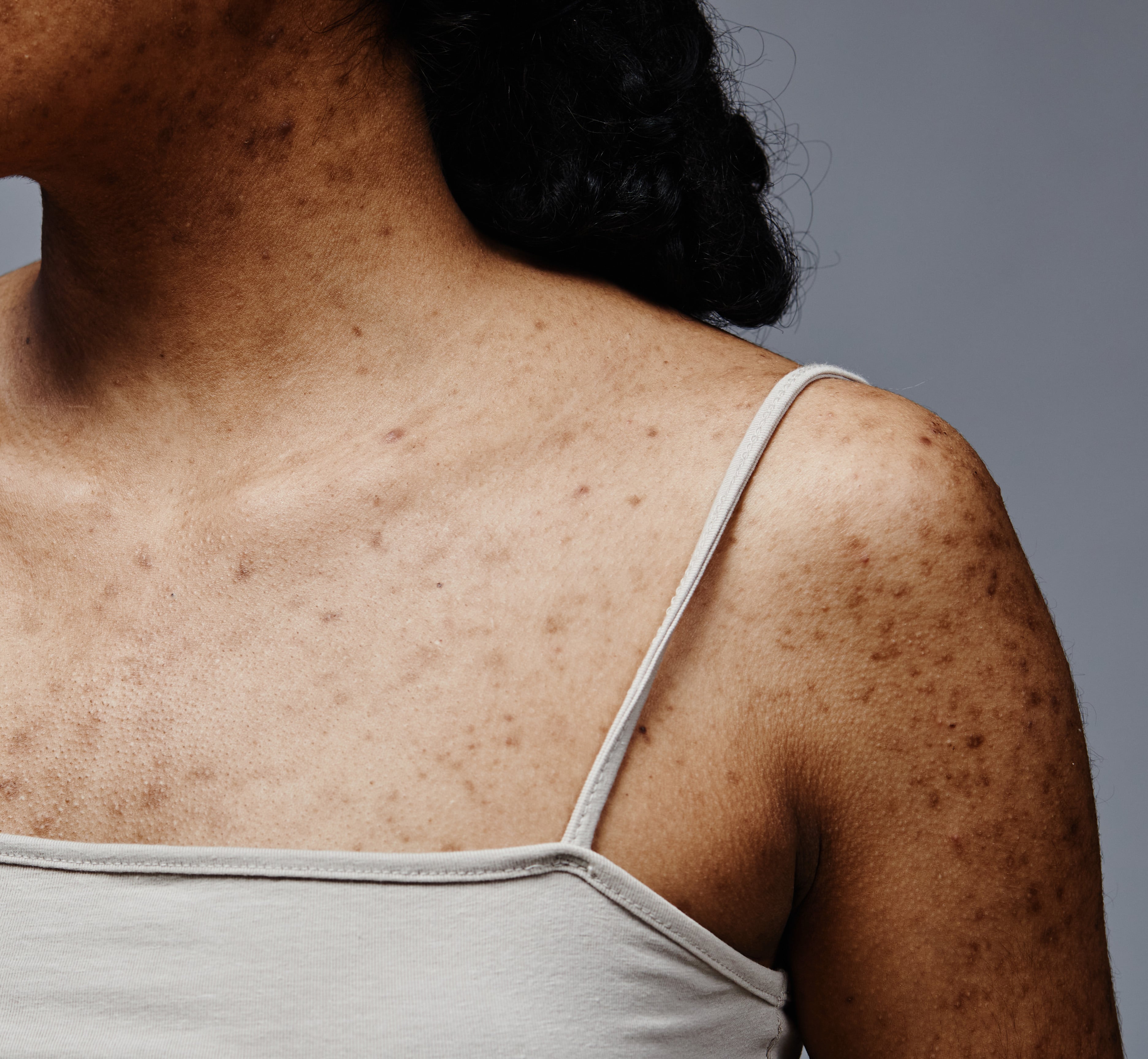 sweat causing pimples on back