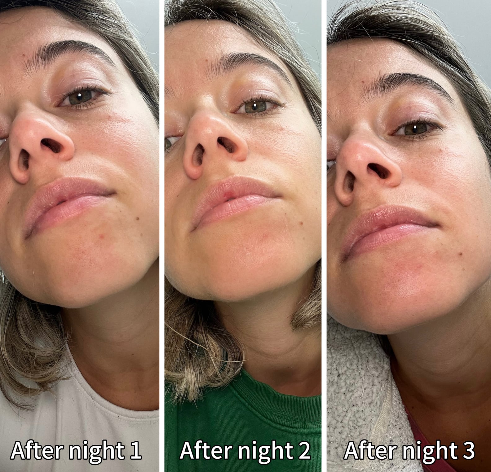 Skinfix Acne Adapinoid Gel Review With Photos | PS Beauty