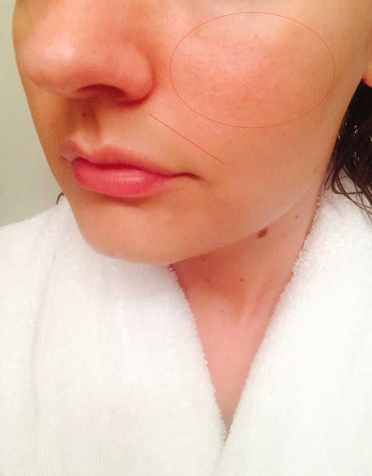 Most Melasma Shows Up Symmetrically On The Cheeks On The Forehead Melasma Treatment
