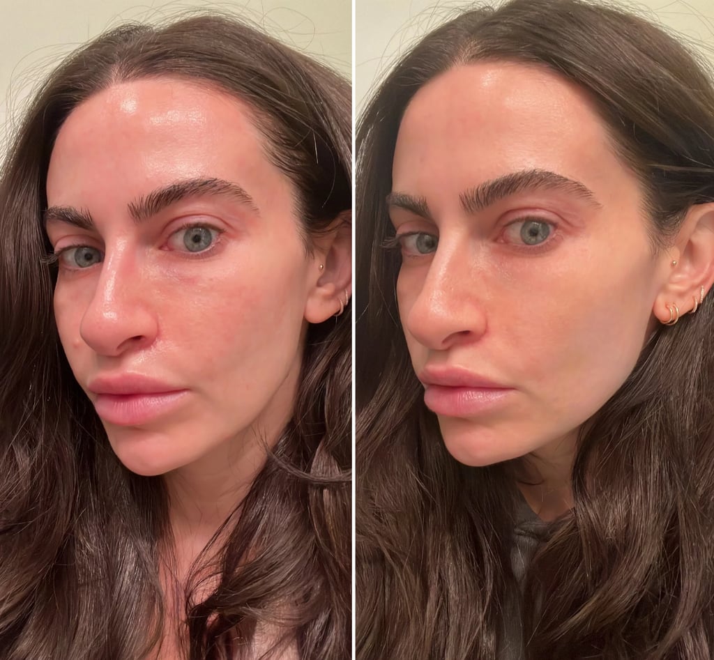 Honest Lyma Laser Review With Before and After Pictures | POPSUGAR ...