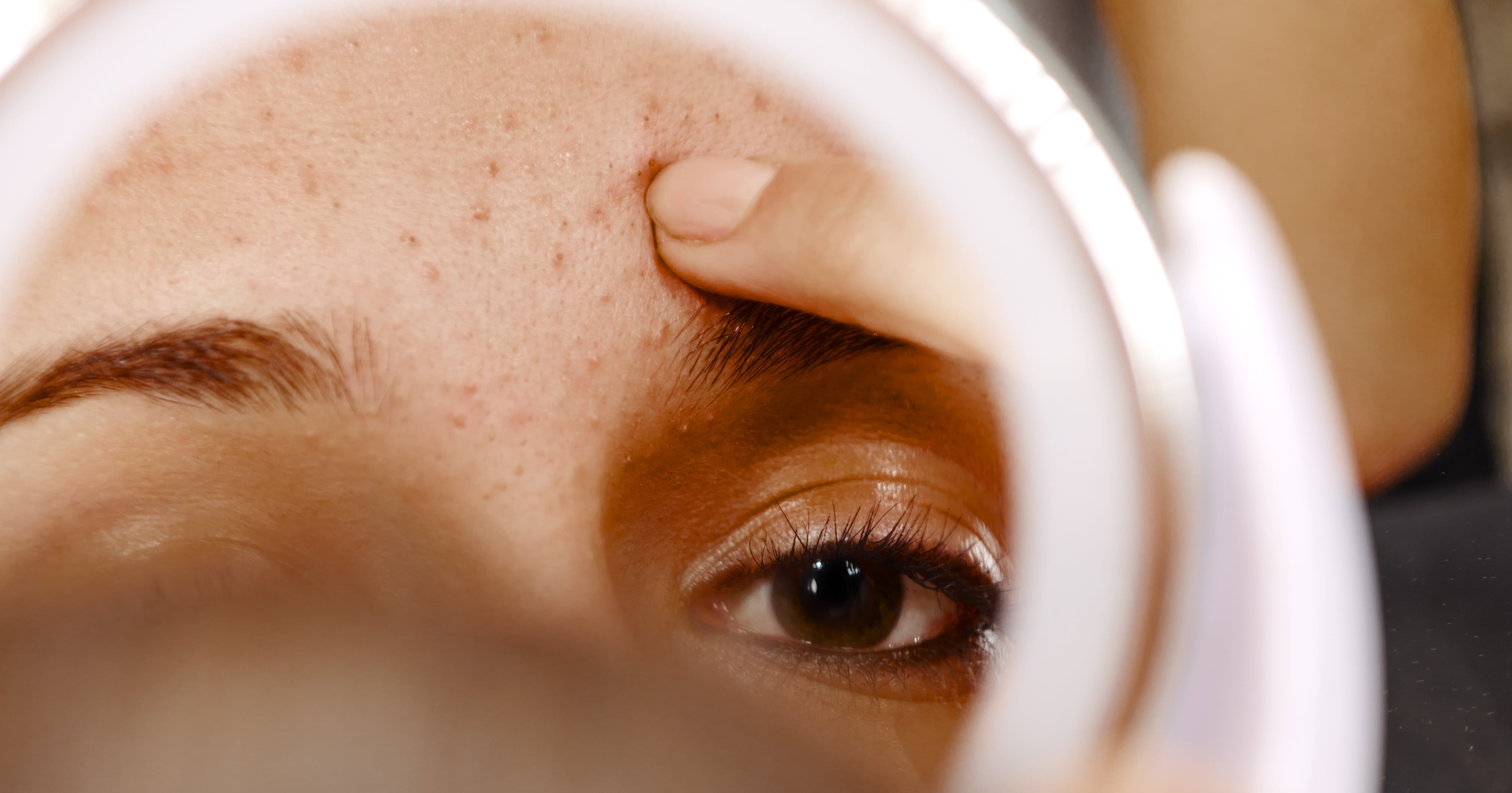 What Is Papulopustular Acne Rosacea And How To Treat It Ps Beauty