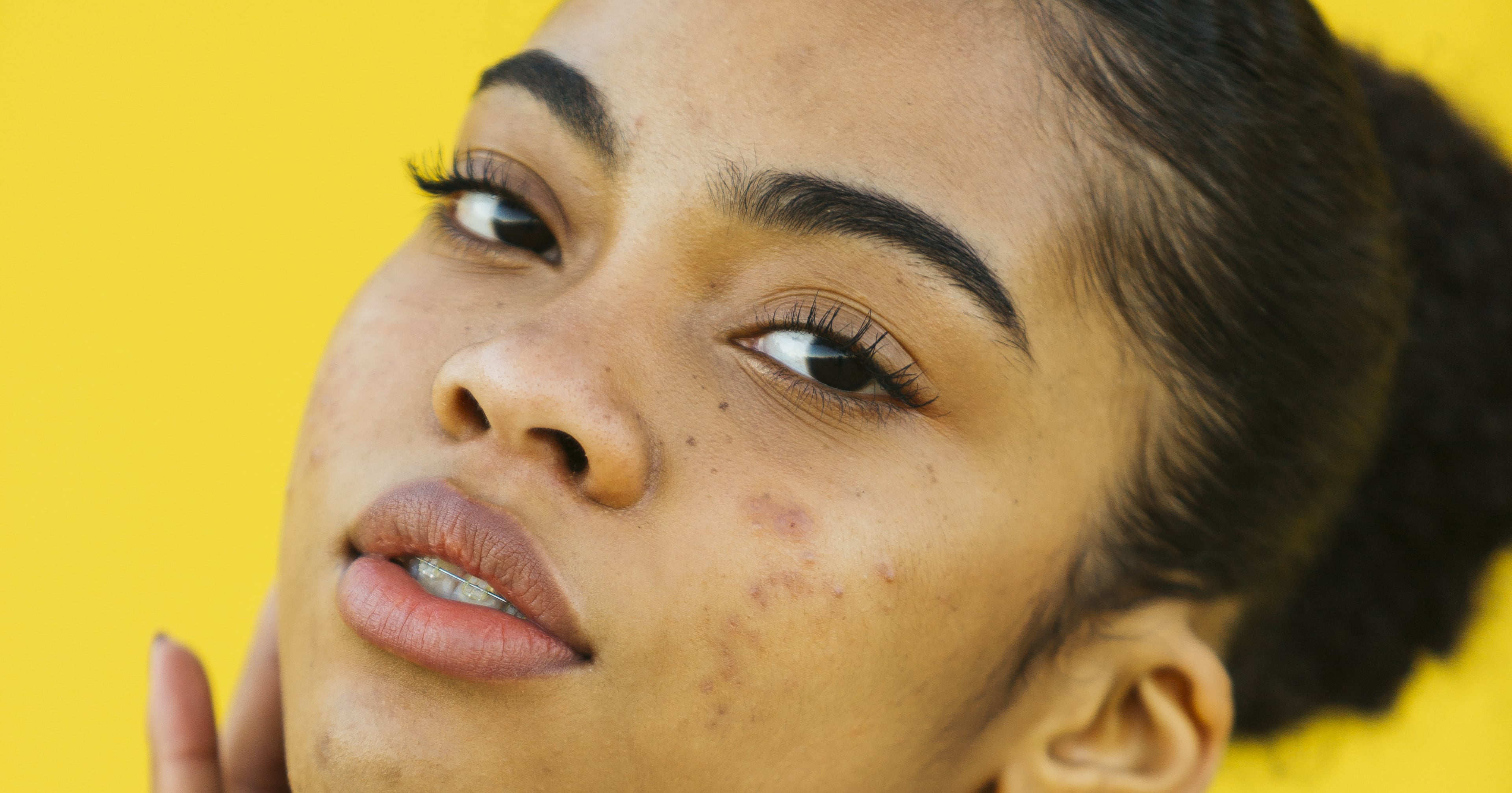 Facial Acne Mapping on Forehead, Cheeks, Chin, and Nose | PS Beauty