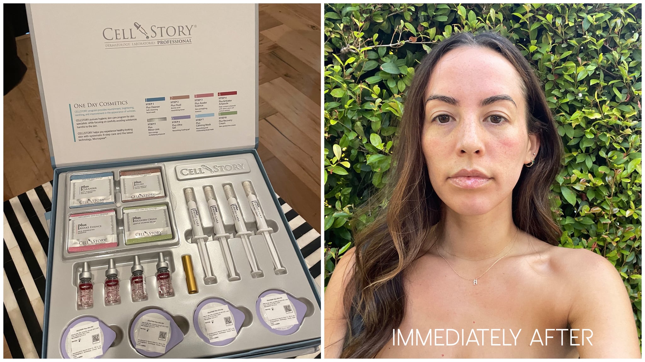 I Tried a Liquid Microneedling Treatment: See Photos | POPSUGAR Beauty UK