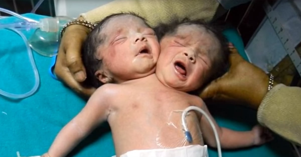Baby in Bangladesh Born With 2 Heads | PS Family