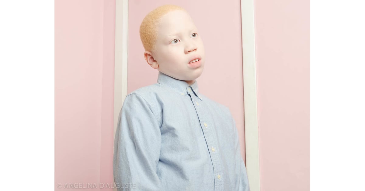 Albinism Photographs | POPSUGAR Beauty Photo 13