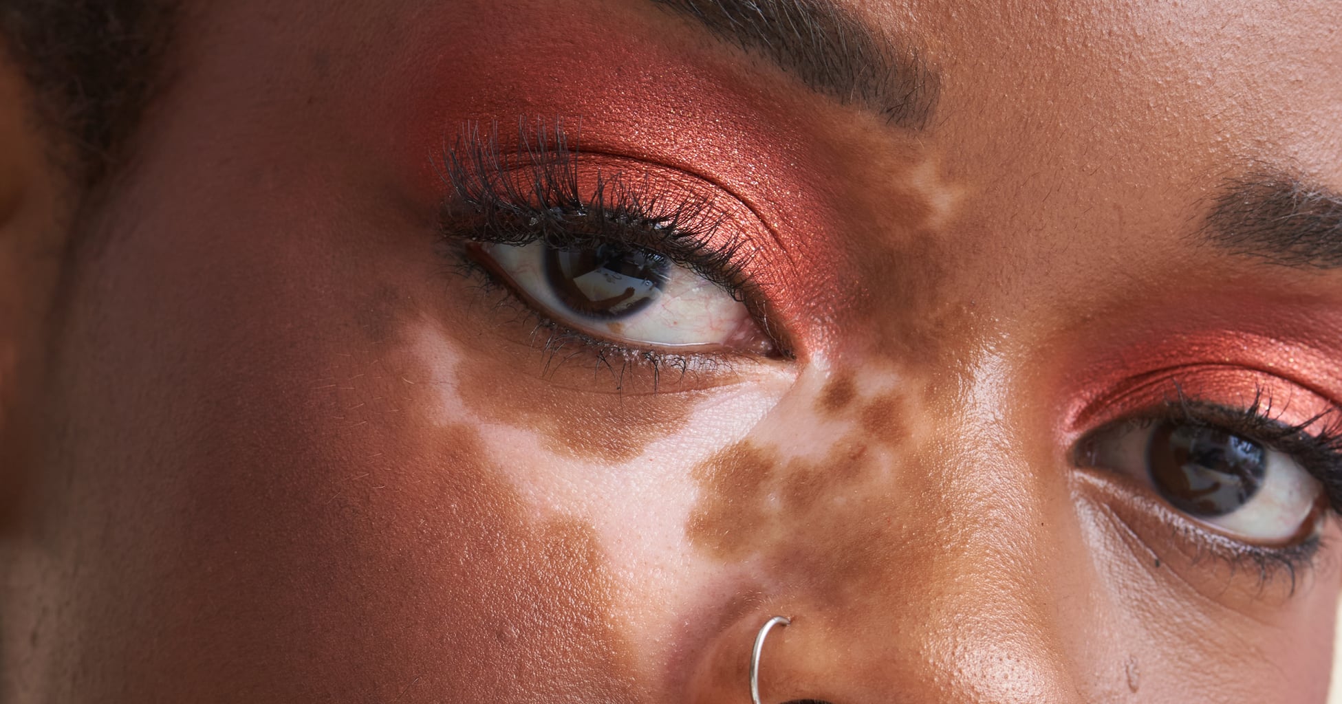 Vitiligo Skin Condition Causes and Treatments | PS Beauty
